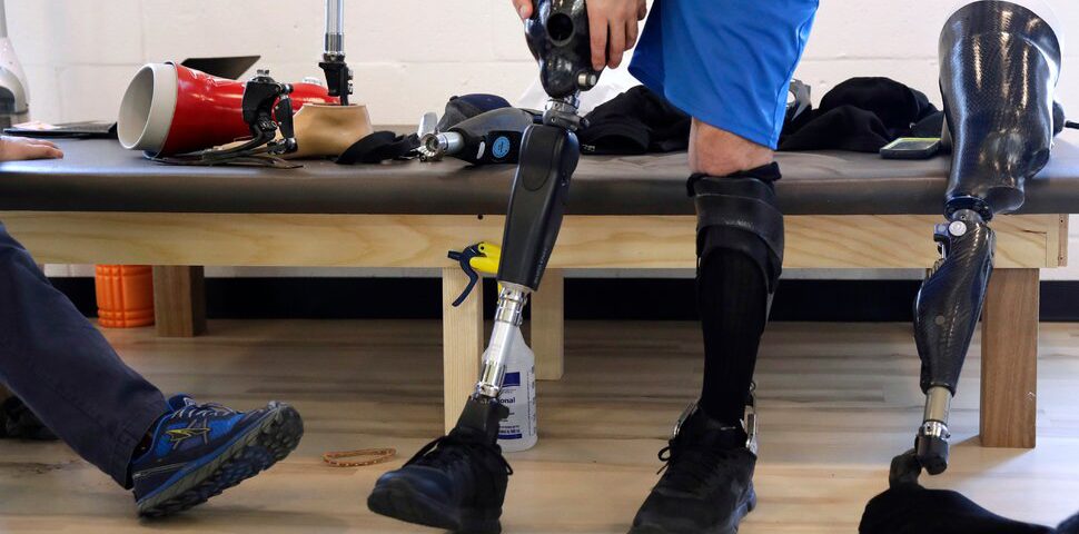 prosthetic leg above knee Archives - Transforming lives with precision ...