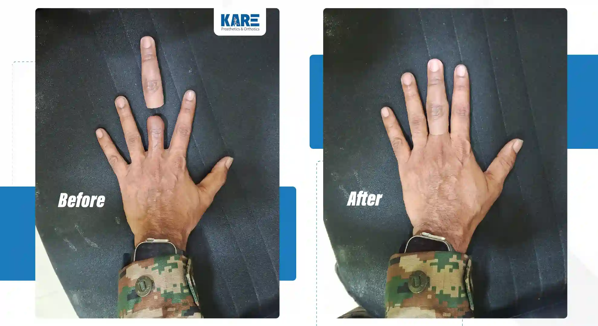 Can Artificial Fingers Replace a Lost Finger | What Do They Cost